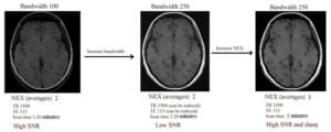 MRI NEX (averages) and image quality | Number of excitations(NEX) or ...