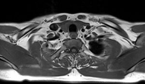 T1 MRI | MRI T1 weighted sequences