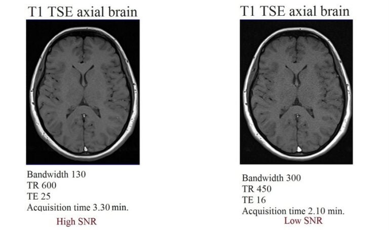 MRI bandwidth and image quality | How to manipulate transmitter ...