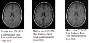 Signal-to-Noise Ratio (SNR) in MRI | Factors affecting SNR
