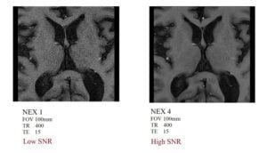 Signal-to-Noise Ratio (SNR) in MRI | Factors affecting SNR