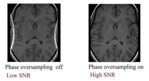 Signal-to-Noise Ratio (SNR) in MRI | Factors affecting SNR