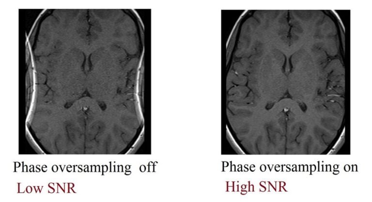 Signal-to-Noise Ratio (SNR) in MRI | Factors affecting SNR