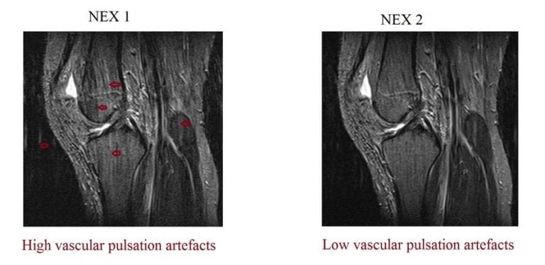 MRI NEX (averages) and image quality | Number of excitations(NEX) or ...