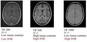 Signal-to-Noise Ratio (SNR) in MRI | Factors affecting SNR
