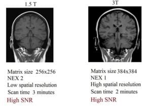 Signal-to-Noise Ratio (SNR) in MRI | Factors affecting SNR