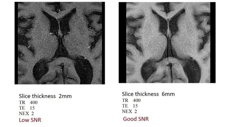Signal-to-Noise Ratio (SNR) in MRI | Factors affecting SNR