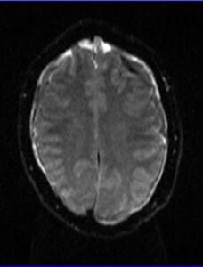 MRI Subdural haemorrhage images