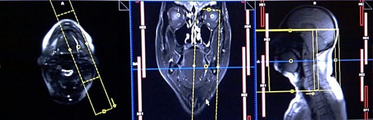MRI Sialography Planning | MRI Sialography Protocols & Indications