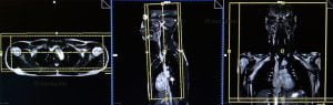 Magnetic Resonance Angiography(MRA) Subclavians Protocols and Planning ...