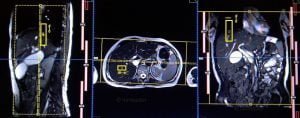 MRI planning of MRCP uncooperative patients