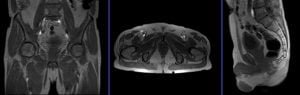 MRI rectal cancer protocols and planning | Indications for MRI rectal ...