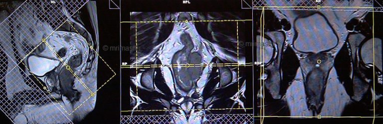 PLAN RECTAL CA PELVIS normal variation - mrimaster