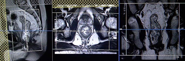 PLAN RECTAL CA PELVIS normal variation - mrimaster