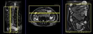 Abdominal wall MRI Protocol, Planning and Indications