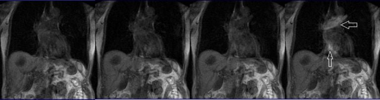 MRI Kidneys (Renal) Planning | MRI Kidneys Protocol and Indications