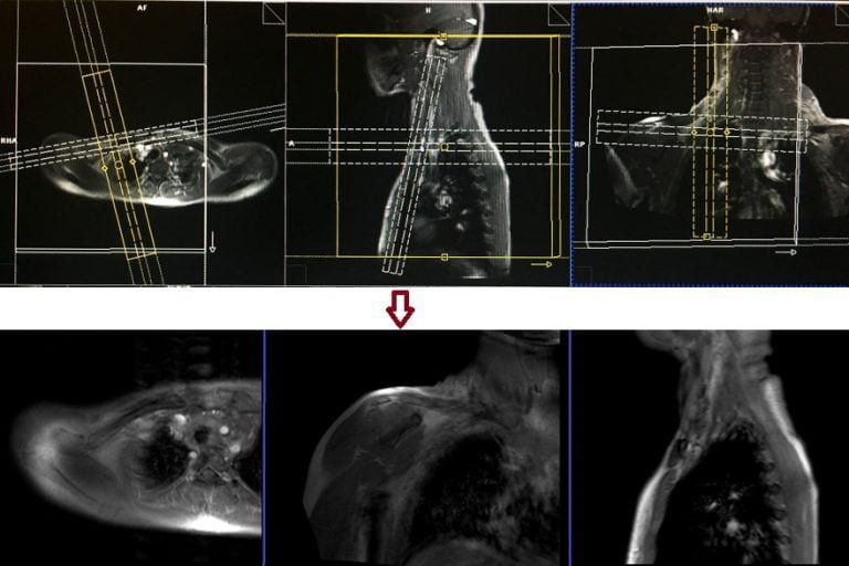 MRI Clavicle Protocols, Planning , Positioning and Indications