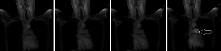 Magnetic Resonance Angiography(MRA) Subclavians Protocols and Planning ...