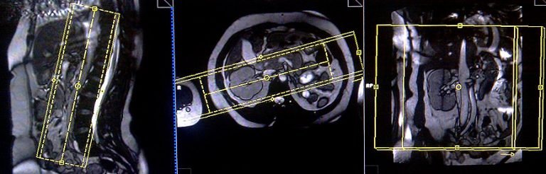 PLAN MRA RENAL normal variation - mrimaster