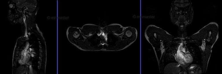 Magnetic Resonance Angiography(MRA) Subclavians Protocols and Planning ...