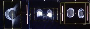 Breast implant MRI Scan Protocols and Planning