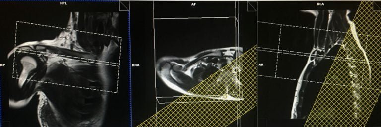 MRI Clavicle Protocols, Planning , Positioning and Indications