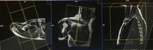MRI Clavicle Protocols, Planning , Positioning and Indications