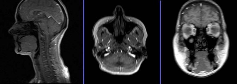 Malignant Otitis Externa (MOE) MRI Protocols and Planning | MRI ...