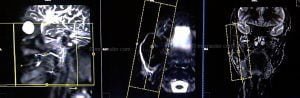 MRI Sialography Planning | MRI Sialography Protocols & Indications
