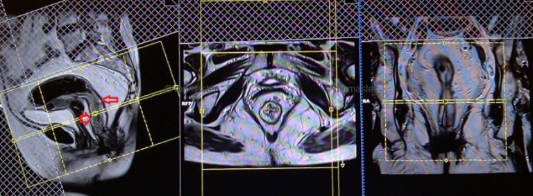 PLAN RECTAL CA PELVIS normal variation - mrimaster