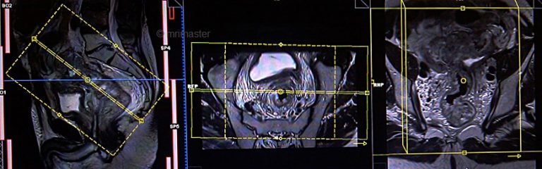 PLAN RECTAL CA PELVIS normal variation - mrimaster