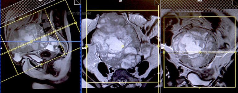 PLAN RECTAL CA PELVIS normal variation - mrimaster