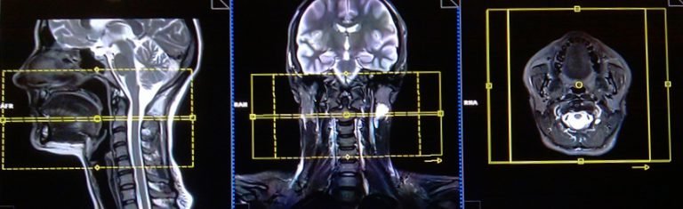 MRI Sialography Planning | MRI Sialography Protocols & Indications