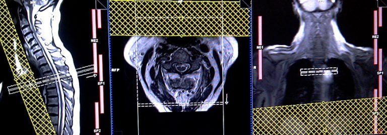 PLAN T SPINE Variations in planning - mrimaster