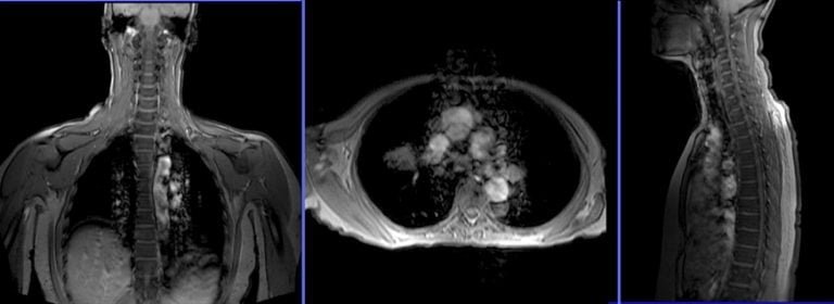 Thoracic spine MRI Planning and Protocols | Indications for MRI ...