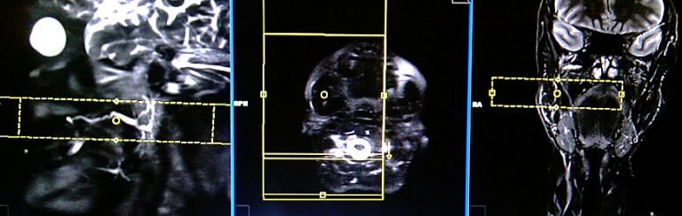 MRI Sialography Planning | MRI Sialography Protocols & Indications