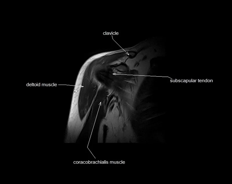 MRI Shoulder Anatomy | Shoulder Coronal Anatomy | Free Cross Sectional ...
