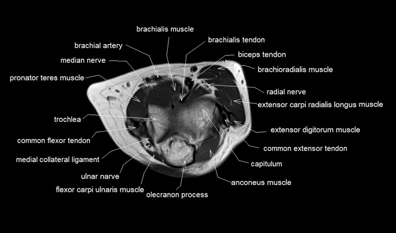 Elbow Muscle Anatomy Mri The Radiology Assistant : MRI Examination Of