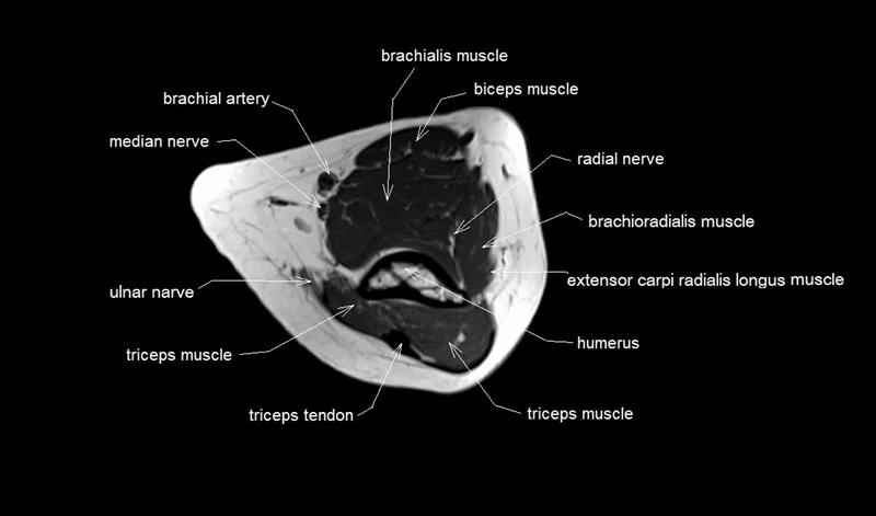Elbow Muscle Anatomy Mri The Radiology Assistant : MRI Examination Of