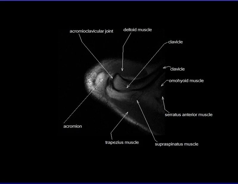 Shoulder Anatomy Axial Mri Labeled