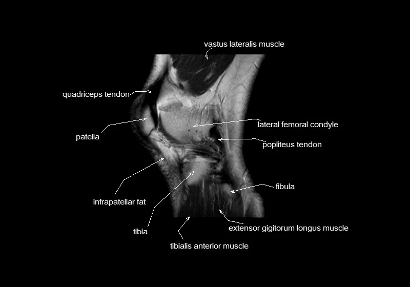 Knee Joint Mri Anatomy