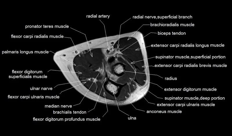 Mri Cross Sectional Anatomy MRI Of Upper Limb: Normal Anatomy