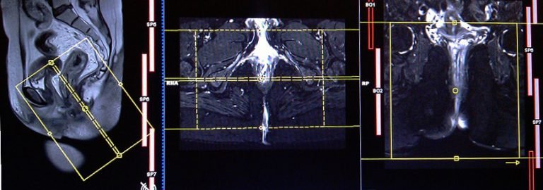 PLAN FISTULA normal variation planning - mrimaster