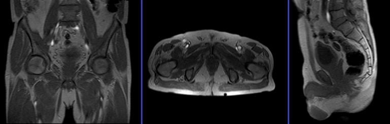 MRI proctogram planning | MRI proctogram protocols | Indications for ...