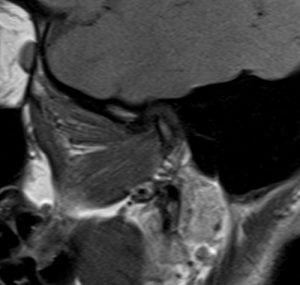MRI temporomandibular joint sagittal close mouth PD images of right side