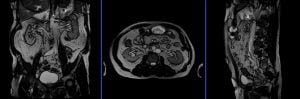 MRI Urography Planning | Urography Protocols | Indications for MRI ...
