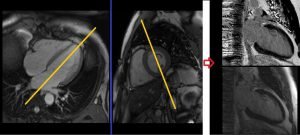 Cardiac MRI protocols, Planning and Techniques | Positioning for ...