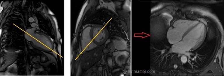 Cardiac Stress Perfusion MRI Protocols, Planning and Techniques