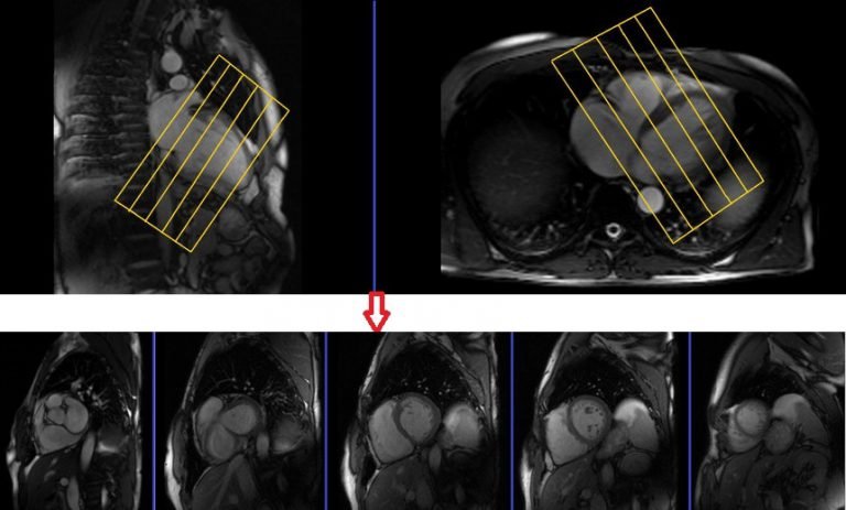 MRI Cardiac T1 Mapping | T2 Mapping & T2* Mapping