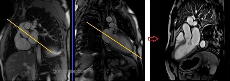 Cardiac MRI protocols, Planning and Techniques | Positioning for ...